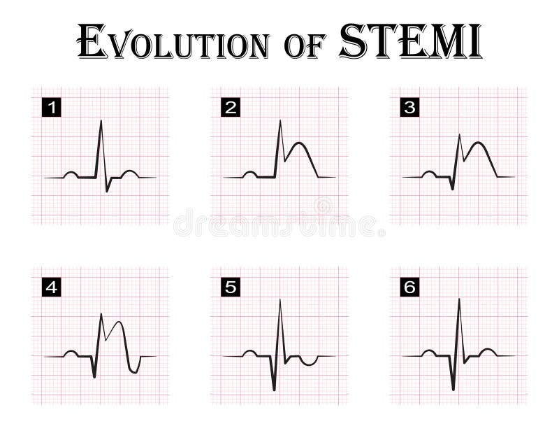ECG of Evolution ( Step by Step ) of STEMI Stock Vector - Illustration ...