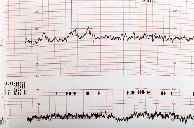 EKG Ecggraf, Elektrokardiogramecg På Papper Arkivfoto - Bild av doktor ...