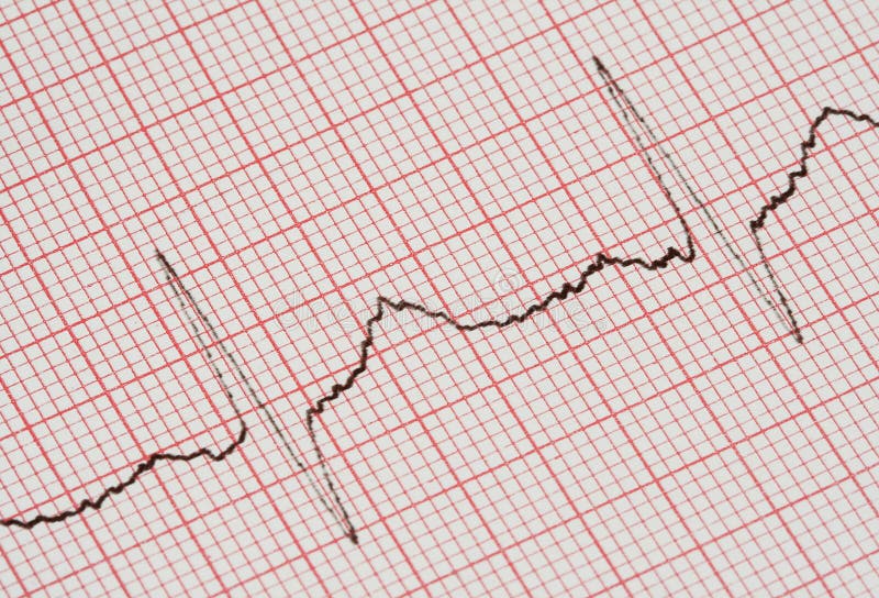 Normal ECG stock photo. Image of healthcare, screen, cardiologist - 1842238