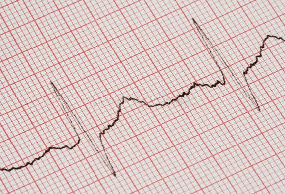 ECG graph stock photo. Image of medicine, heart, cardiology - 2839966