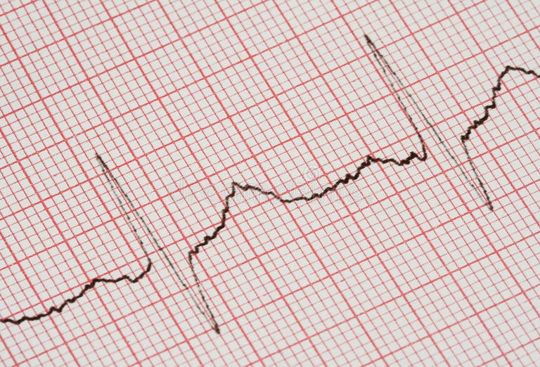 ECG graph stock photo. Image of medicine, heart, cardiology - 2839966
