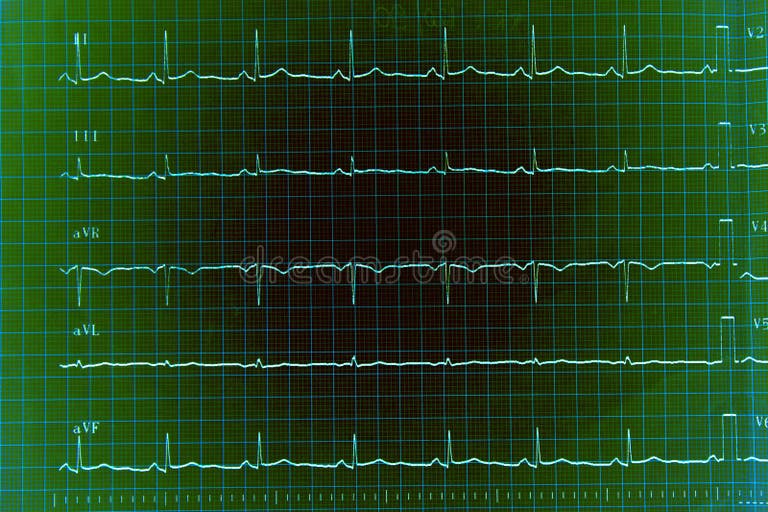 143 Heartbeat Normal Ecg Graph Stock Photos - Free & Royalty-Free Stock ...