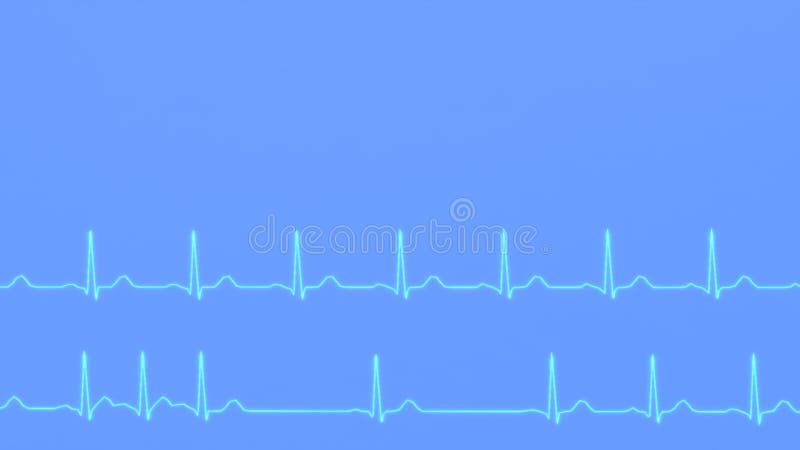 ECG Graphs Comparison of Normal Heart Rhythm and Arrhythmia Stock ...