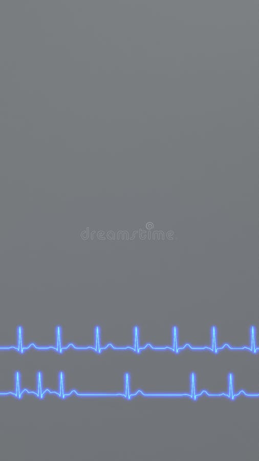 ECG Graphs Comparison of Normal Heart Rhythm and Arrhythmia Stock Photo ...