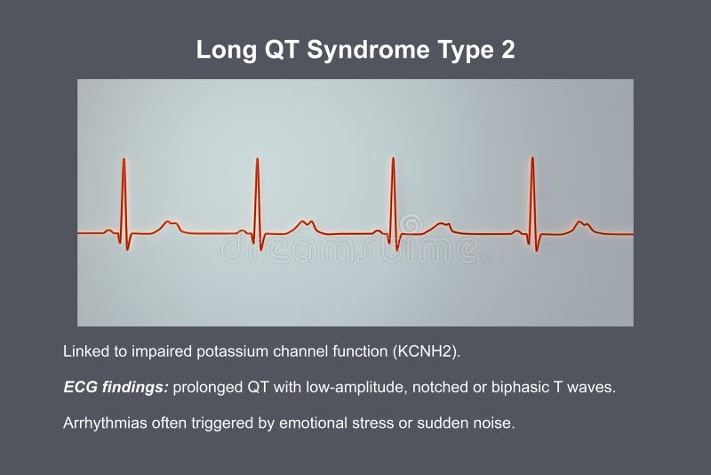 Long Qt Syndrome Type Stock Illustrations – 49 Long Qt Syndrome Type ...