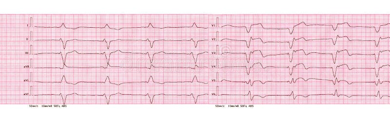 ECG-opname Met Pacemaker-ritme (atriale Pacing) Stock Afbeelding ...