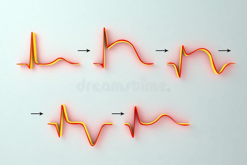 ECG in Myocardial Infarction, Illustration Showing Evolution of ECG ...