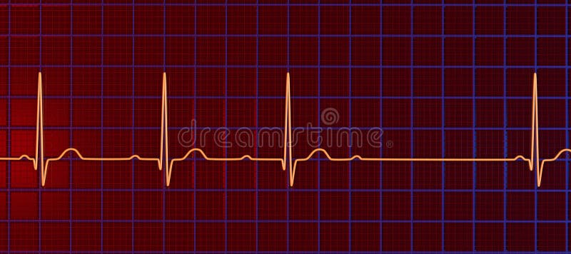 An ECG with 2nd Degree AV Block, 3D Illustration Stock Illustration ...