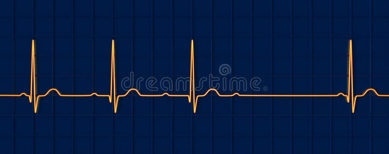 ECG of 3rd Degree AV Block, 3D Illustration Stock Illustration ...