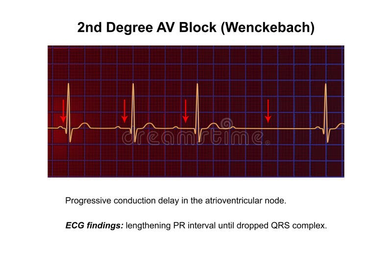 Wenckebach Ecg Disturbances Of Atrioventricular Conduction | Thoracic