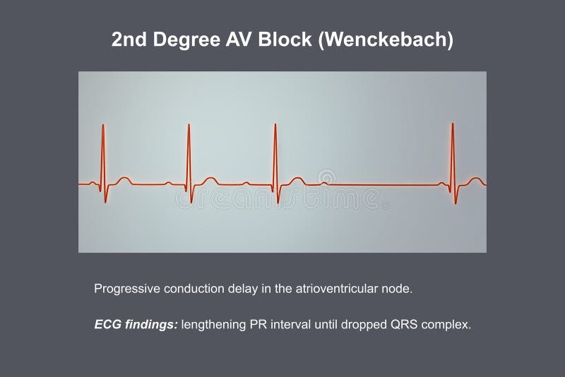 Wenckebach Ecg Disturbances Of Atrioventricular Conduction | Thoracic