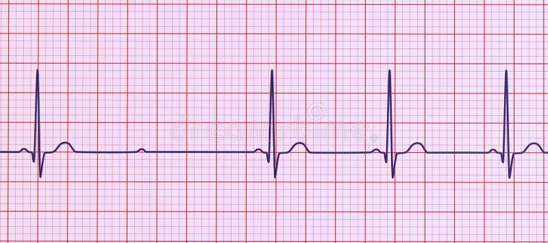 An ECG with 2nd Degree Mobitz 2 AV Block, 3D Illustration Stock ...