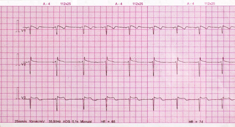ECG print stock image. Image of print, graphic, paper - 13799965