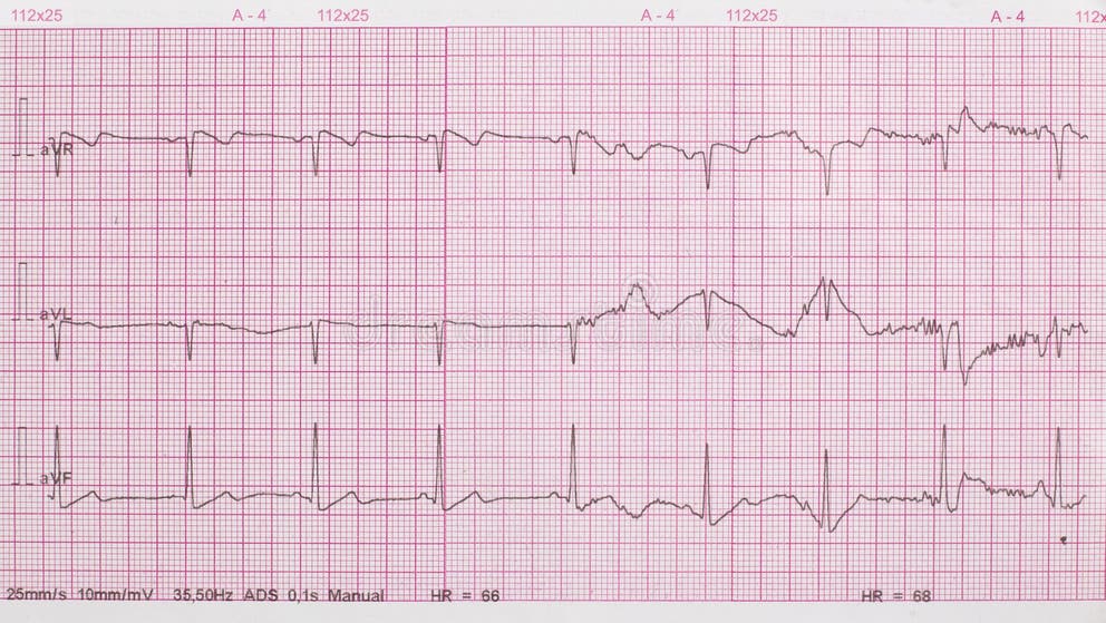 Ecg Printing Stock Photos - Free & Royalty-Free Stock Photos from ...