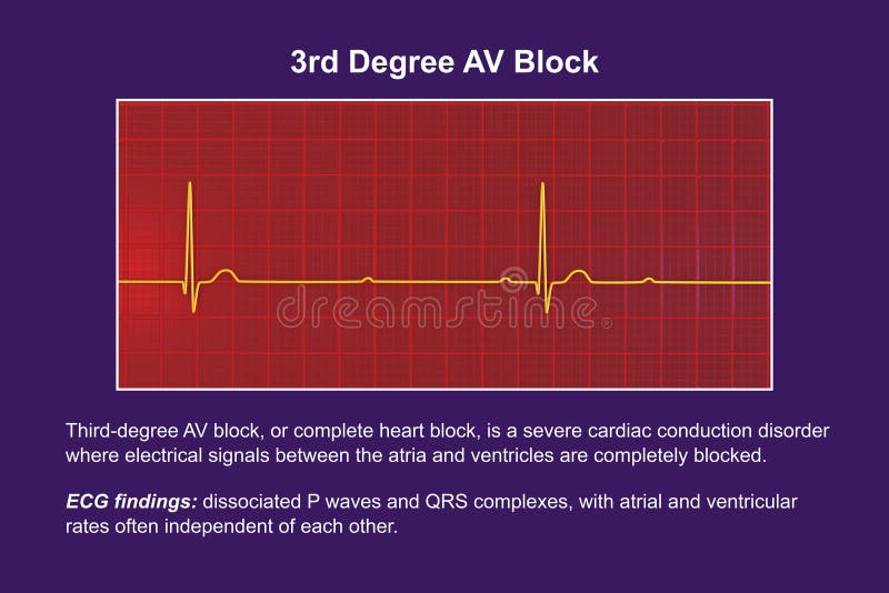 ECG of 3rd Degree AV Block, 3D Illustration Stock Illustration ...