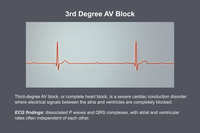 ECG of 3rd Degree AV Block, 3D Illustration Stock Illustration ...