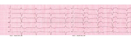 ECG with Rhythm of Artificial Pacemaker Ventricular Pacing Stock Image ...