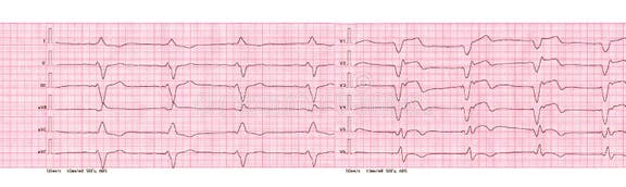 ECG with Rhythm of Artificial Pacemaker Ventricular Pacing Stock Image ...