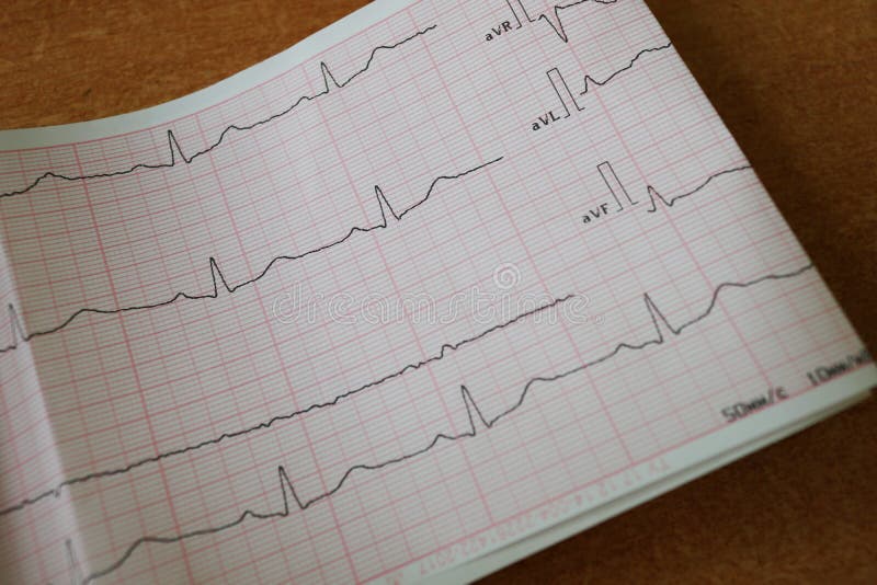 An ecg tape stock image. Image of pattern, tape, line - 226862759