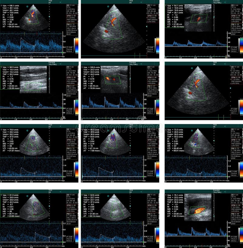 Echo cardiogram stock photo. Image of pancreas, illness - 15566976