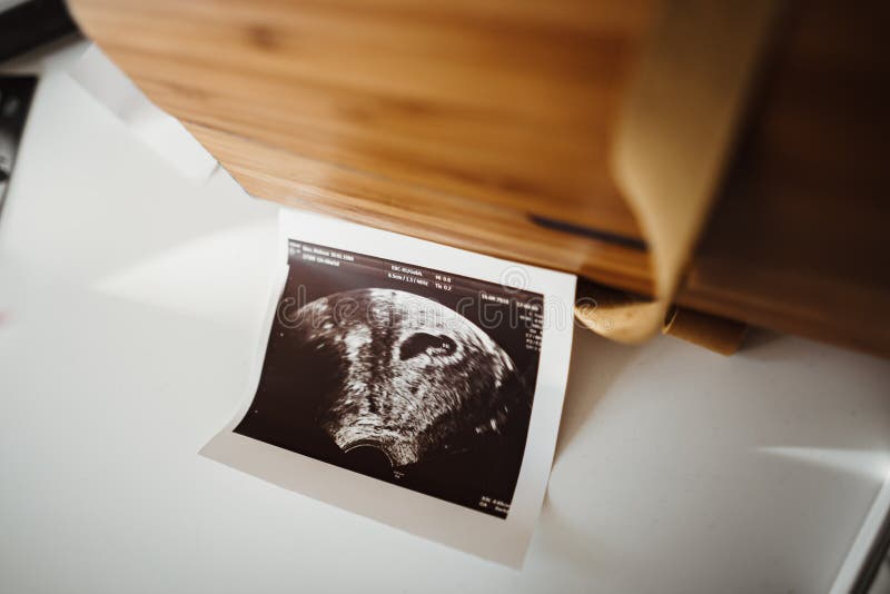 An Echo of an Unborn Baby on the Table Stock Photo - Image of prenatal ...