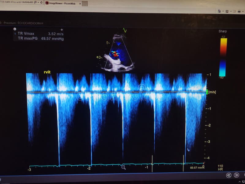 Echocardiogram Colorful Probe Targeting Map and Waveforms Stock Photo ...