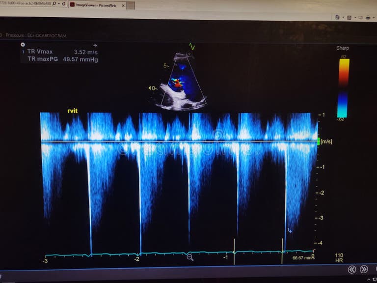 Echocardiogram Colorful Probe Targeting Map and Waveforms Stock Photo ...