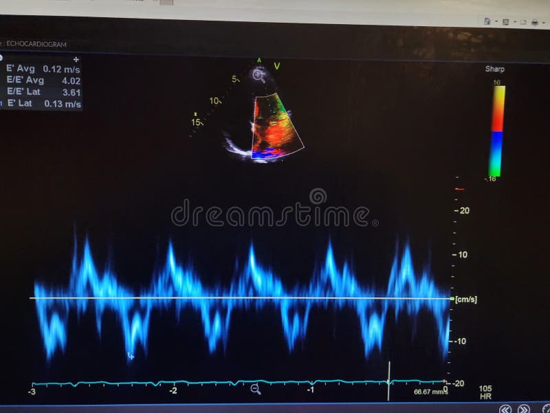 Echocardiogram Colorful Probe Targeting Map and Waveforms Stock Image ...