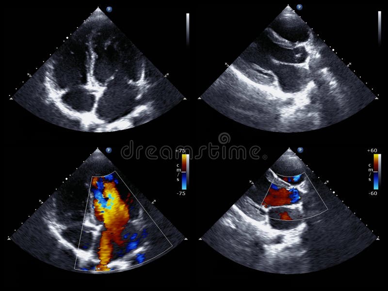 Echocardiography stock photo. Image of echocardiography - 53346214