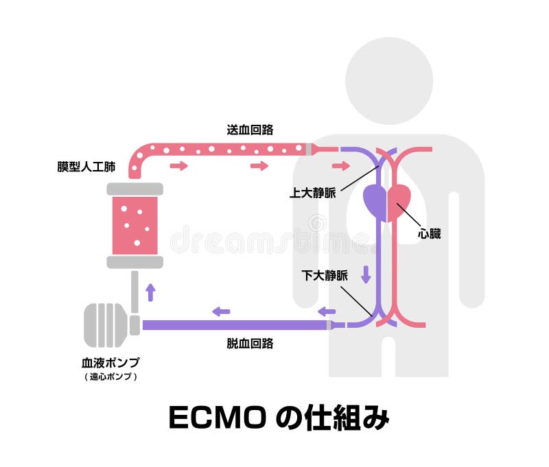 Oxygenation Ecmo Stock Illustrations – 43 Oxygenation Ecmo Stock ...