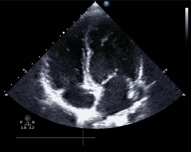 Ecocardiogramma immagine stock. Immagine di medico, setto - 52730929
