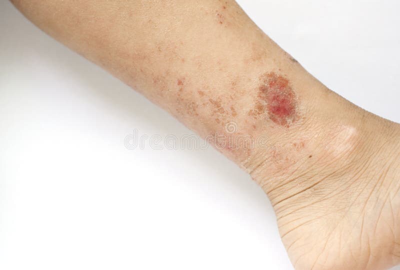 1,084 Eczema Sur La Jambe Photos libres de droits et gratuites de ...