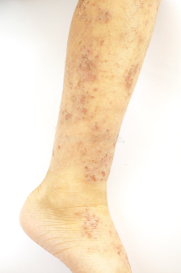 1,084 Eczema Sur La Jambe Photos libres de droits et gratuites de ...