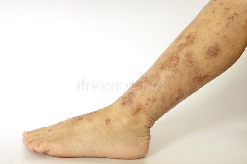 1,084 Eczema Sur La Jambe Photos libres de droits et gratuites de ...