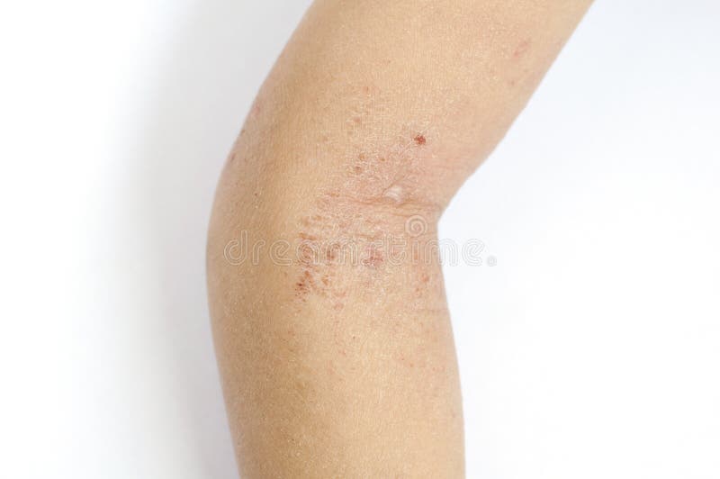Eczema En Las Piernas Del Niño Imagen de archivo - Imagen de pierna ...