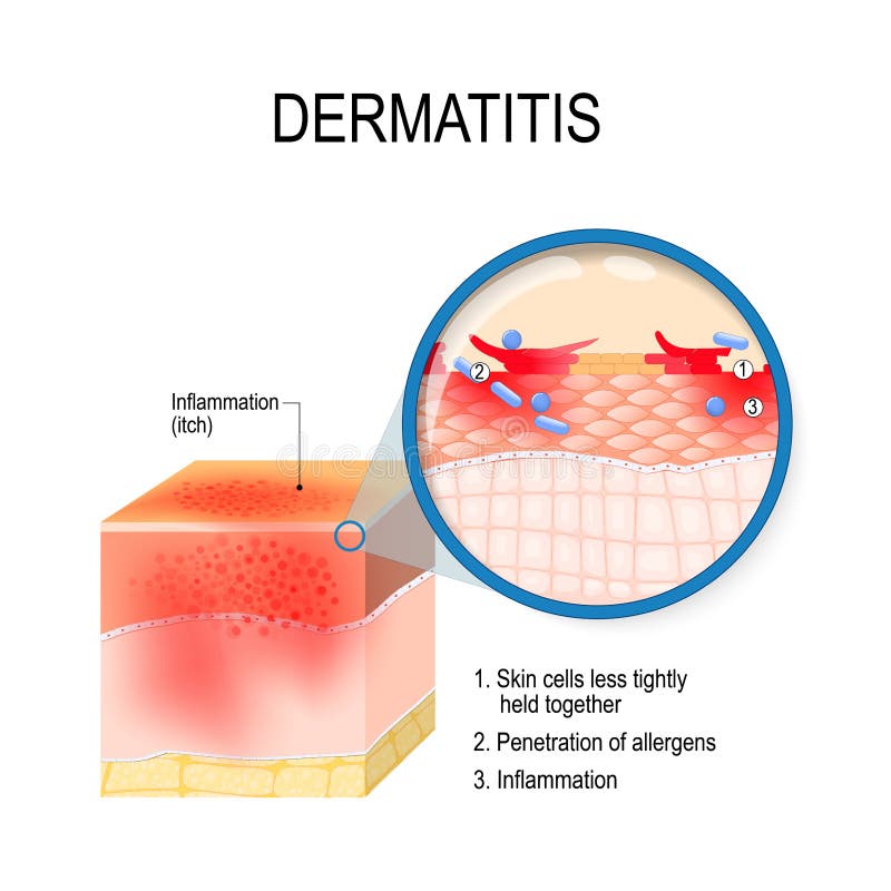 Eczema Atopico Della Dermatite Atopica Illustrazione Vettoriale ...