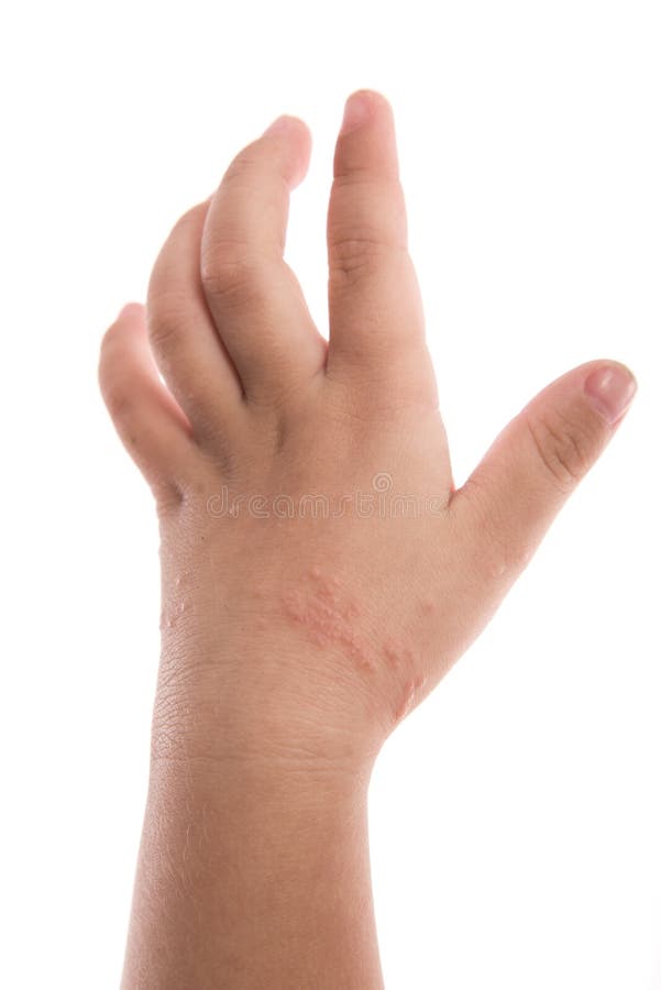 Herpes Zoster In A Child Hand. Stock Photo - Image of sores, health ...