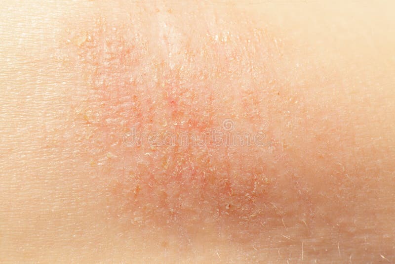 Eczema on skin stock photo. Image of healthcare, peeling - 8959704