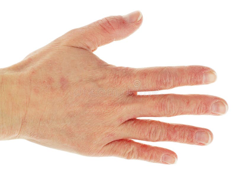 Eczema Dermatitis on Back of Hand Stock Image - Image of back, illness ...