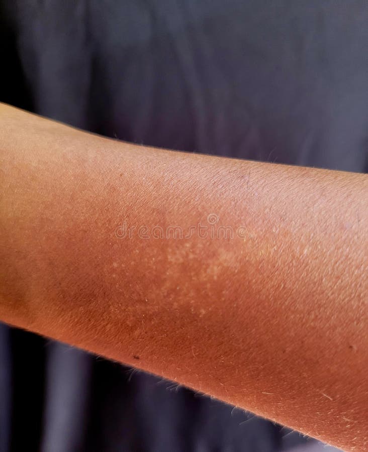 Eczema on forearm imagen de archivo. Imagen de nombres - 259435721