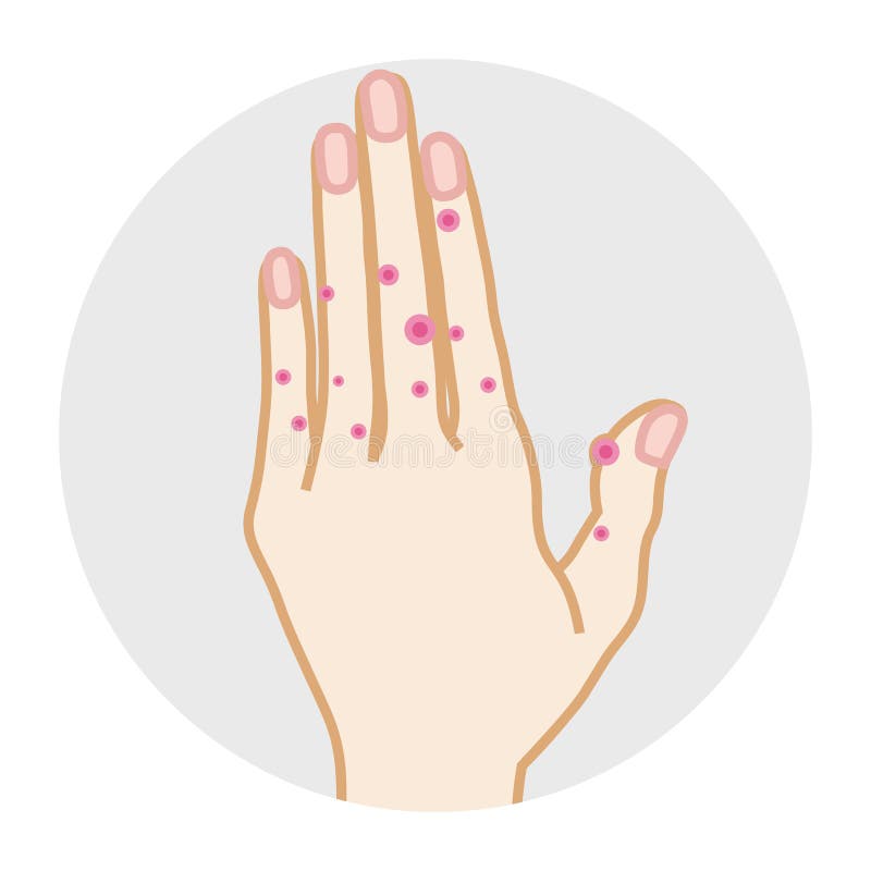 Eczema Vector Illustration. Labeled Anatomical Structure Comparative ...