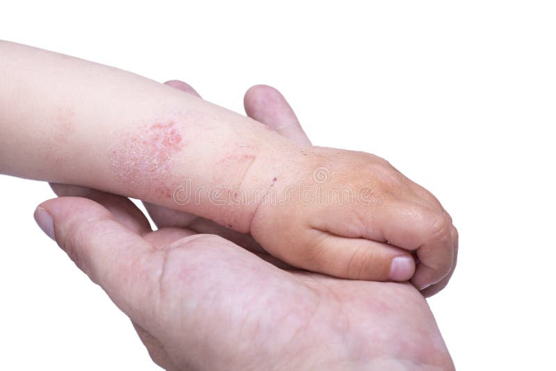 Eczema on the kid s hand stock photo. Image of closeup - 54144562