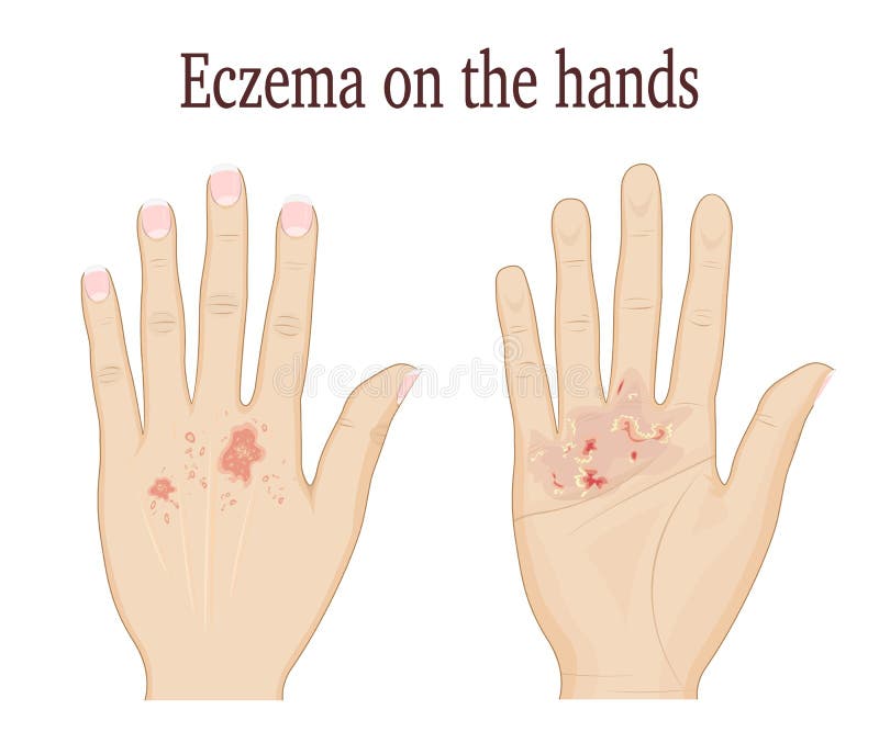 Eczeem op de handen vector illustratie. Illustration of huid - 76617203