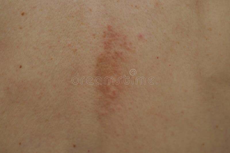 Eczema pimples on a back stock image. Image of medicals - 216259619