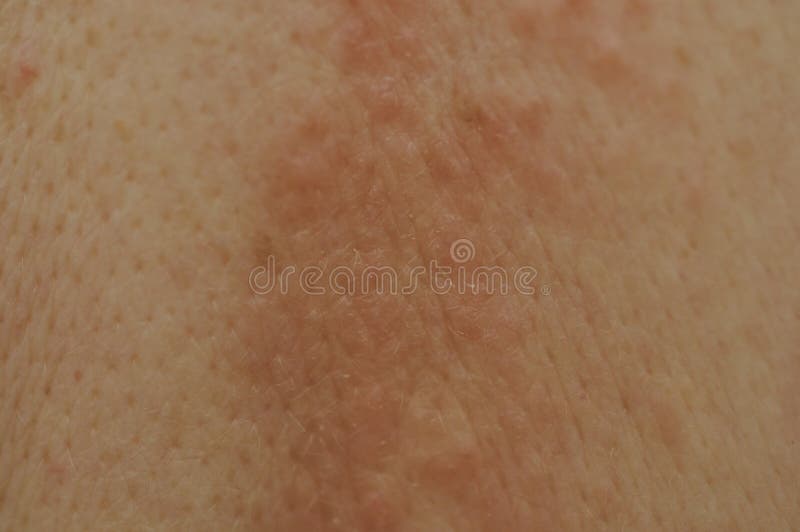 Eczema pimples on a back stock image. Image of dermatologist - 217729981