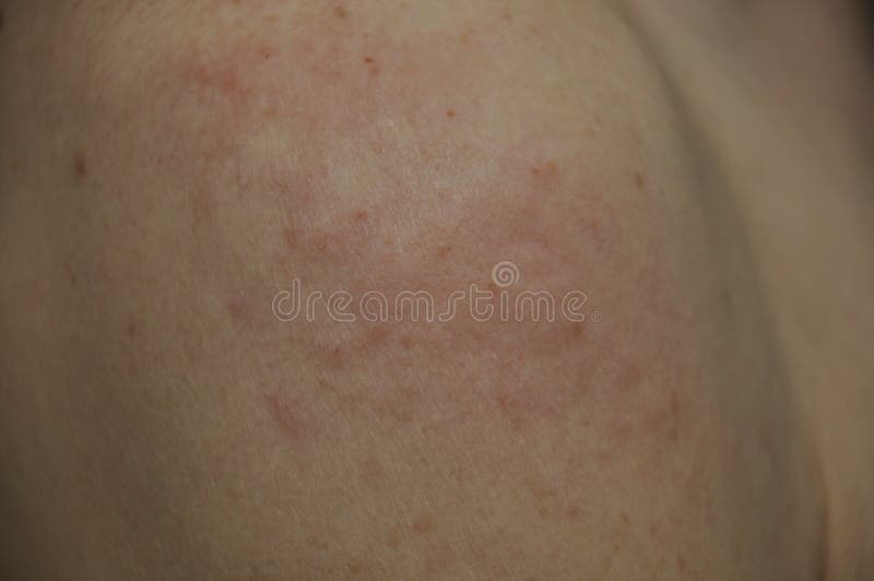 Eczema Pimples on a Shoulder Stock Photo - Image of problems, skin ...