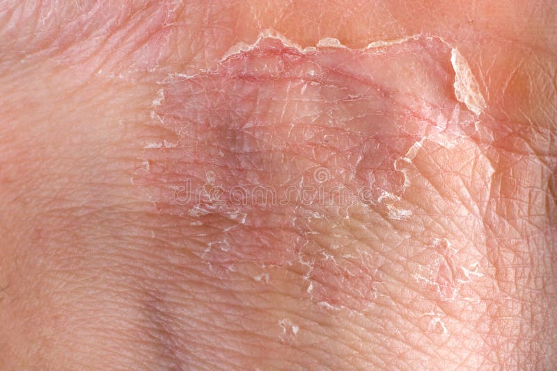 Eczema on skin stock photo. Image of sclerosis, closeup - 8959704