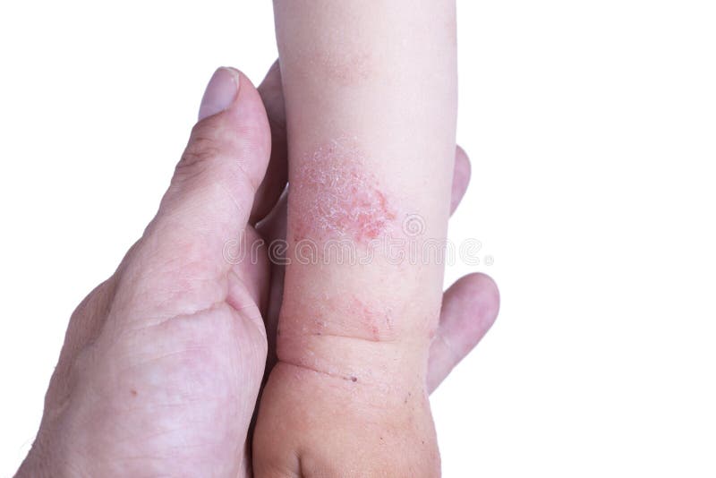 Eczema Sur La Main De L'enfant Image stock - Image du enfant, criqué ...