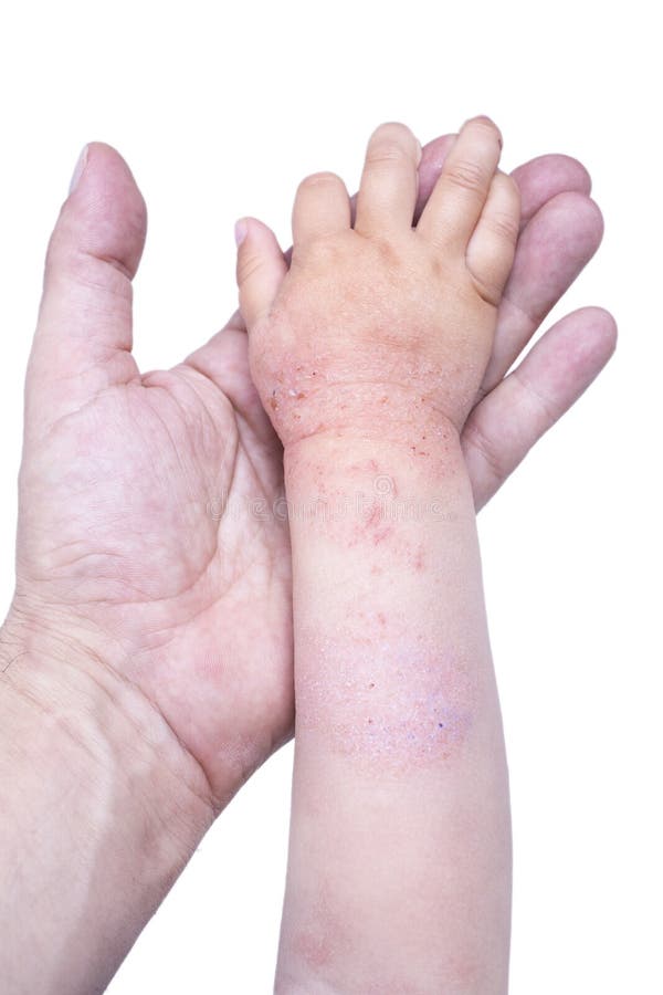 Eczema Sur La Main De L'enfant Photo stock - Image du irritant, rugueux ...