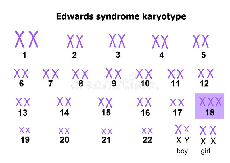 Edwards Syndrome Karyotype Stock Illustration - Image: 51855667